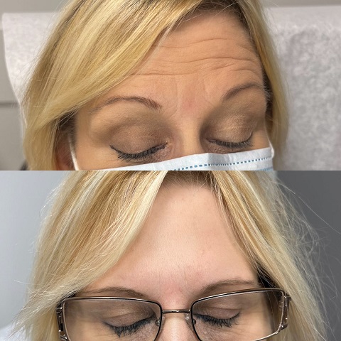 Before And After | MD Treatment Lounge